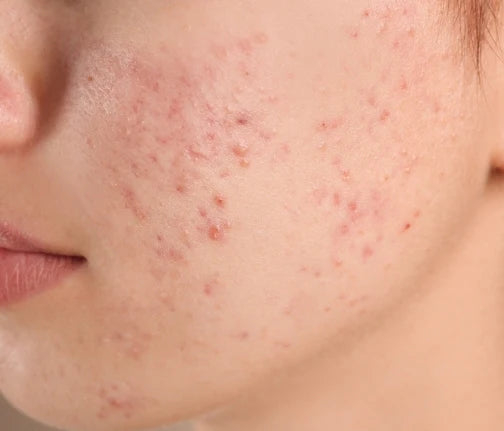 Produits pour Peau Acnéique : The Ordinary, K-Beauty & Plus - FREYA Tunisie